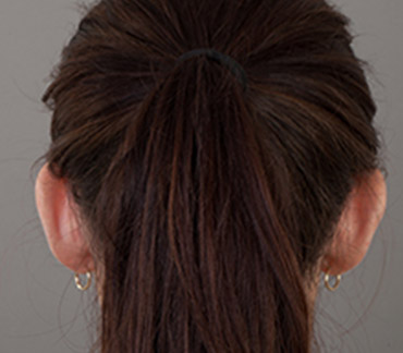 Otoplasty Ear Surgery Gold Coast Plastic Surgery